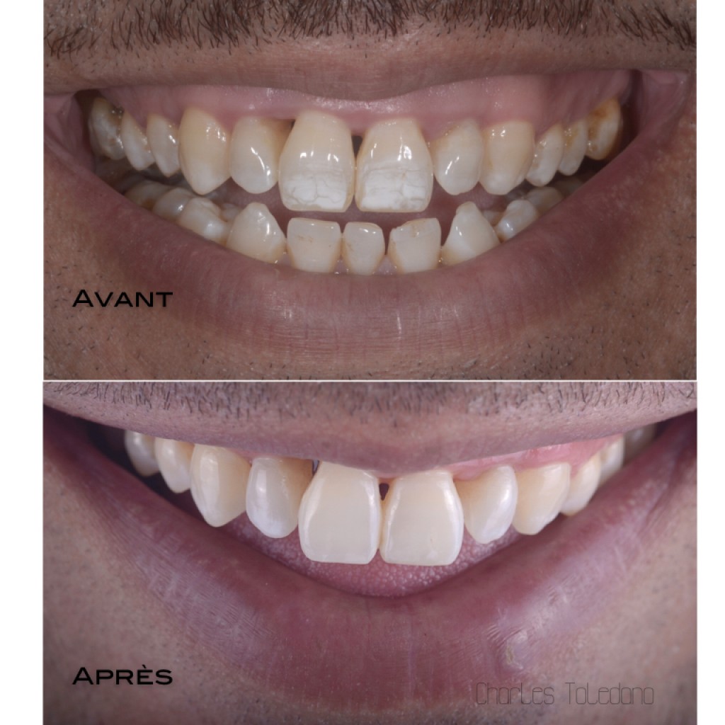 L’érosion infiltration pour traiter les taches blanches - Cabinet ...